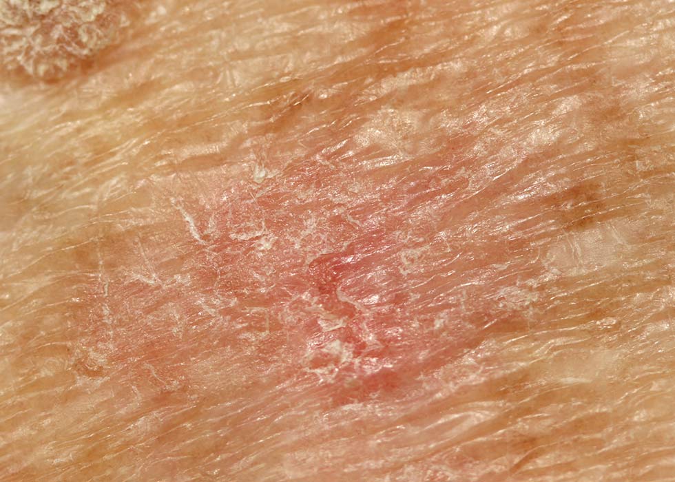 Actinic Keratoses Causes Treatment Dermatology Inc 