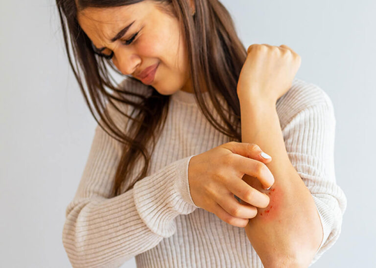 Hives Symptoms & Treatment | Dermatology Inc.