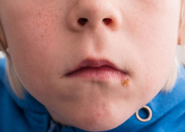 Impetigo Symptoms & Treatments | Dermatology Inc.