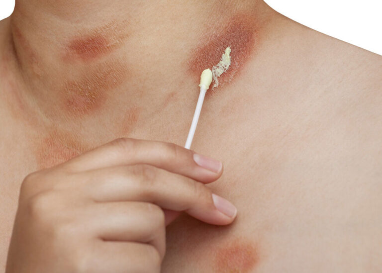 Pityriasis Rosea Causes & Treatments | Dermatology Inc.