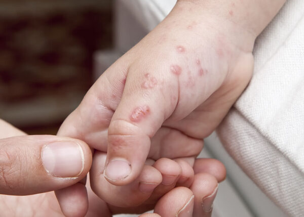 Shingles Causes & Treatments | Dermatology Inc.