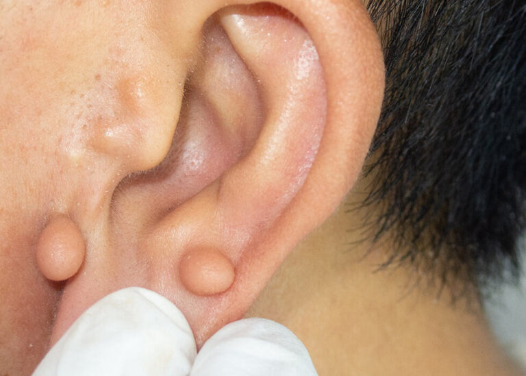 Skin Tags Symptoms & Treatments | Dermatology Inc.